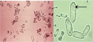Oxalate Crystals Rash Treatment – PainSpy